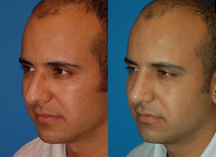 Male Rhinoplasty Photos Melbourne Fl Patient 29167